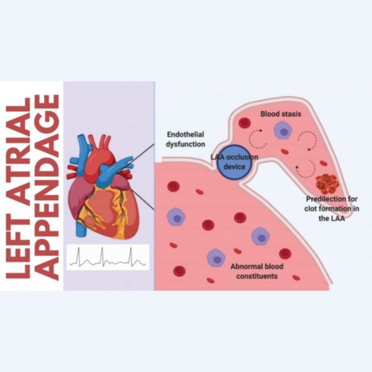 Left Atrial Appendage Closure – Asian Heart and Vascular Center