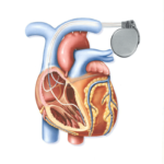 Cardiac Resynchronization Therapy Defibrillator (CRT-D) – Asian Heart ...